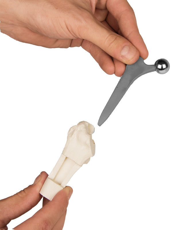 Hip Implant / Replacement Model Set 1115 | Hip Replacement Model ...