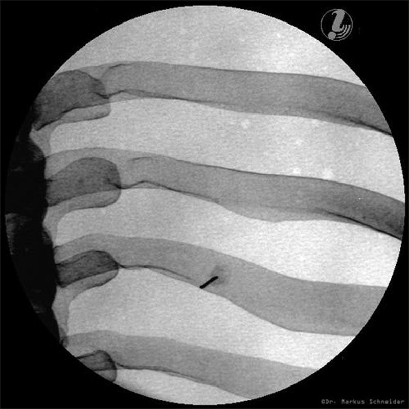 Thoracic Spine Injection Trainer | Spinal Injection Simulator ...