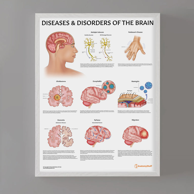 Brain Disease Anatomy Poster | Common Brain Disorders Chart – AnatomyStuff