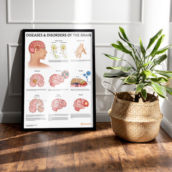 Brain Disease Anatomy Poster | Common Brain Disorders Chart – AnatomyStuff