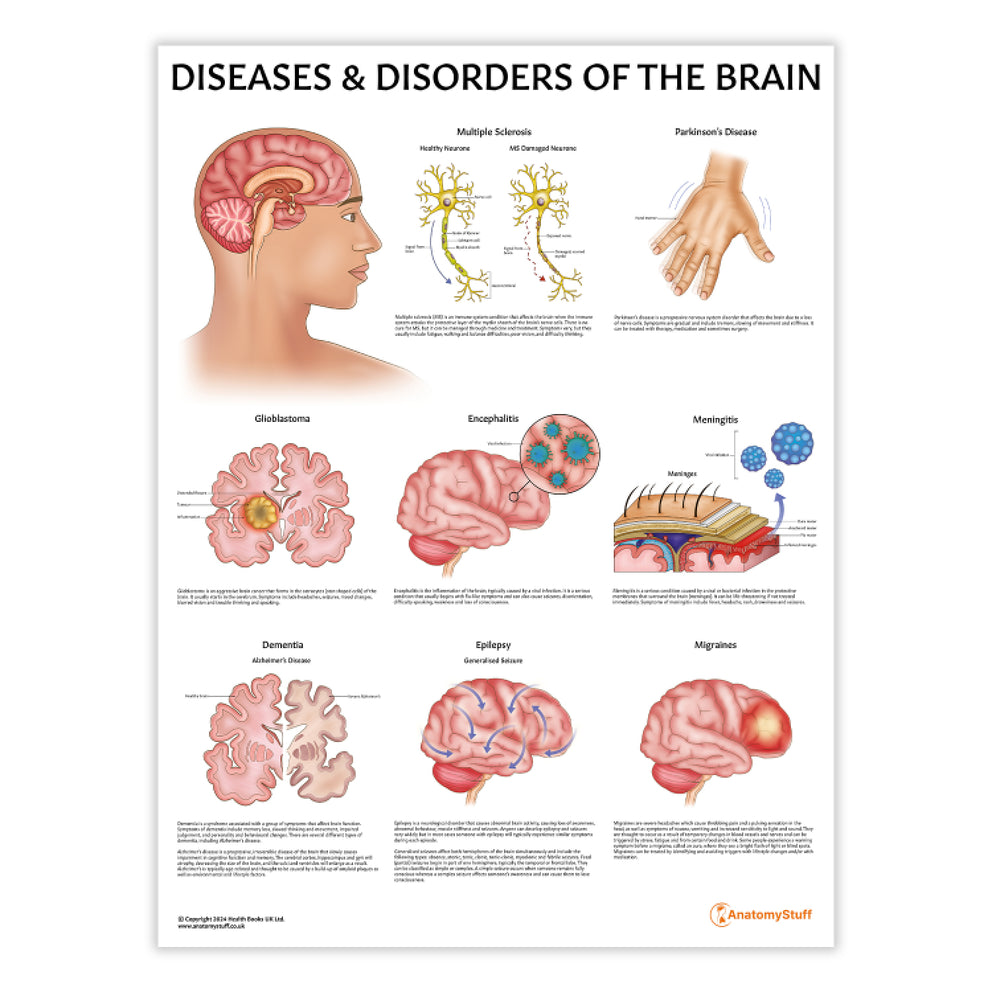 Brain Disease Anatomy Poster | Common Brain Disorders Chart – AnatomyStuff