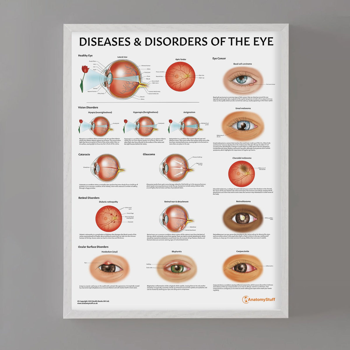 Diseases and Disorders of the Eye Poster | Eye Anatomy Chart – AnatomyStuff