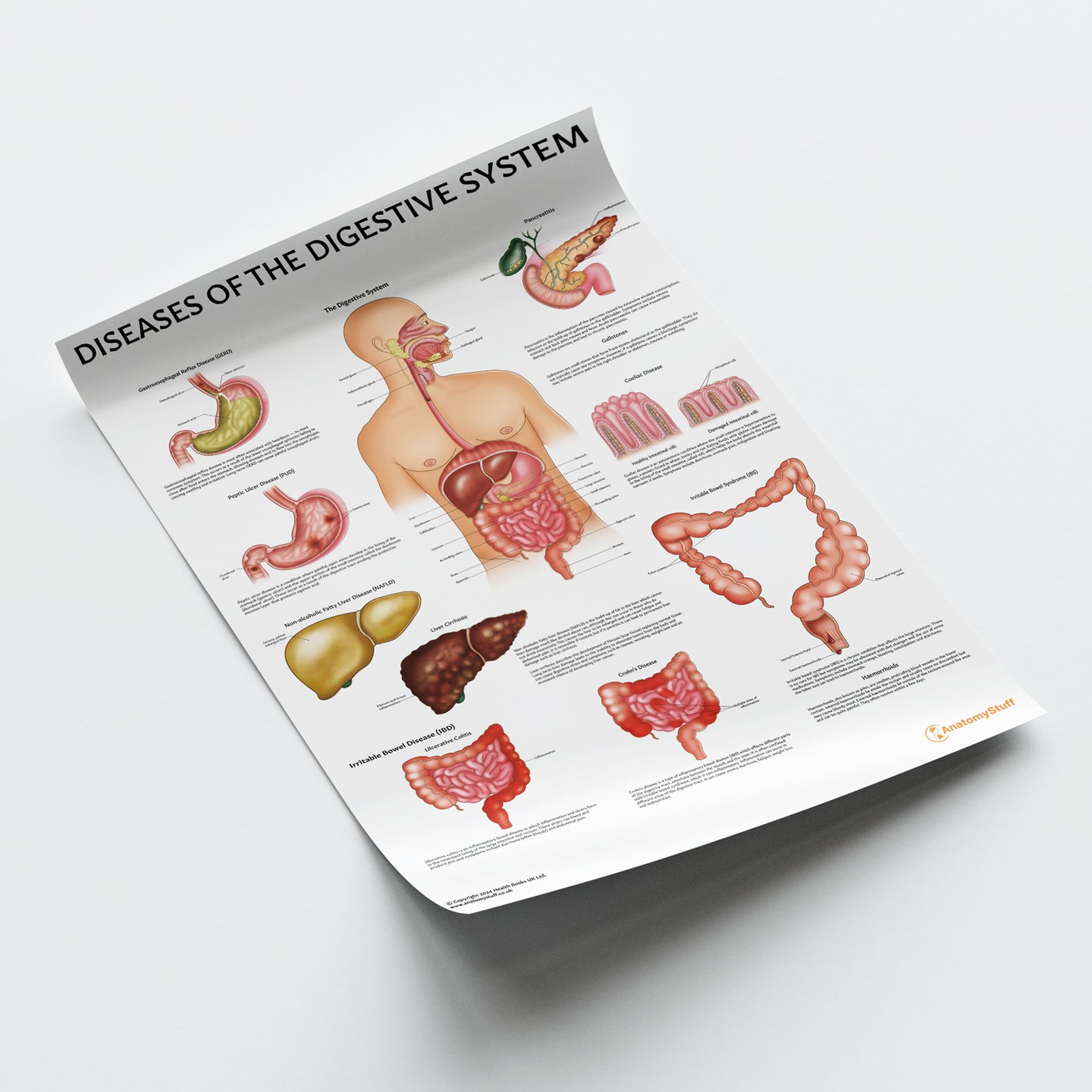 Diseases of the Digestive System Poster | Educational Anatomy Chart ...
