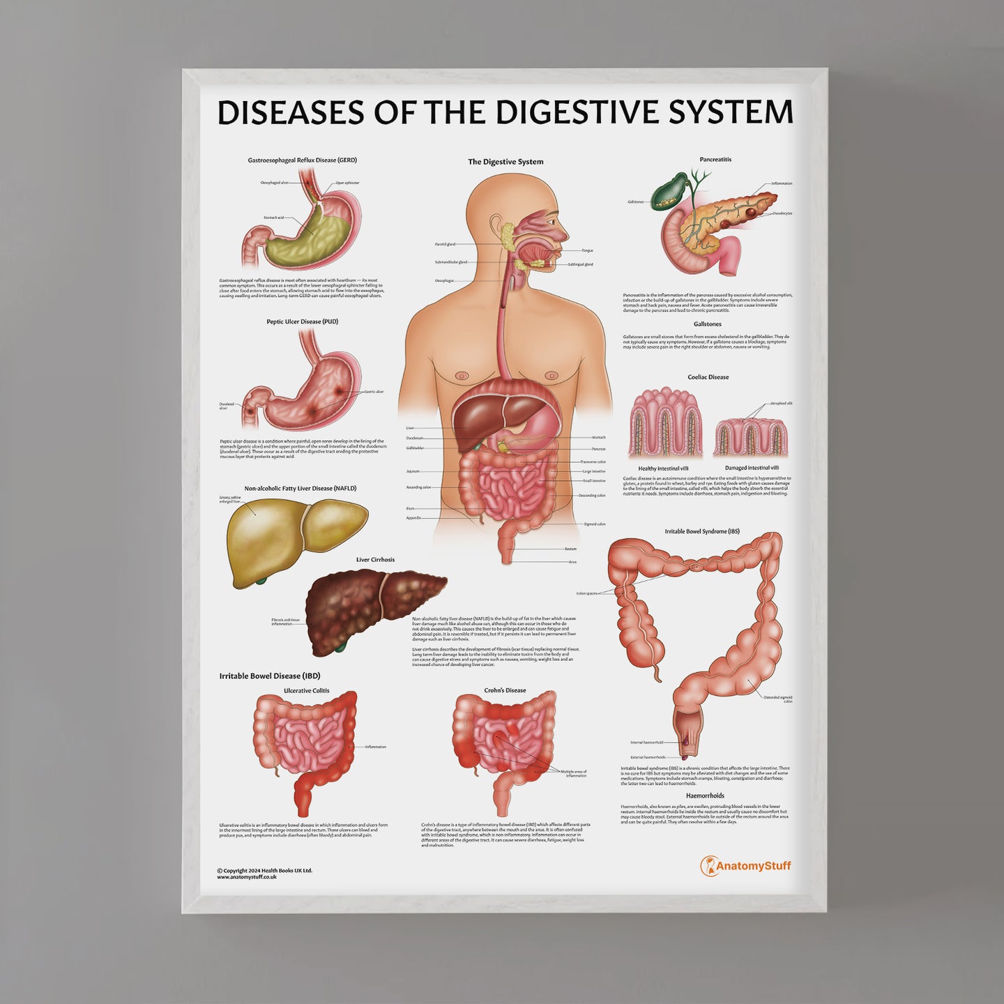 Diseases of the Digestive System Poster | Educational Anatomy Chart ...