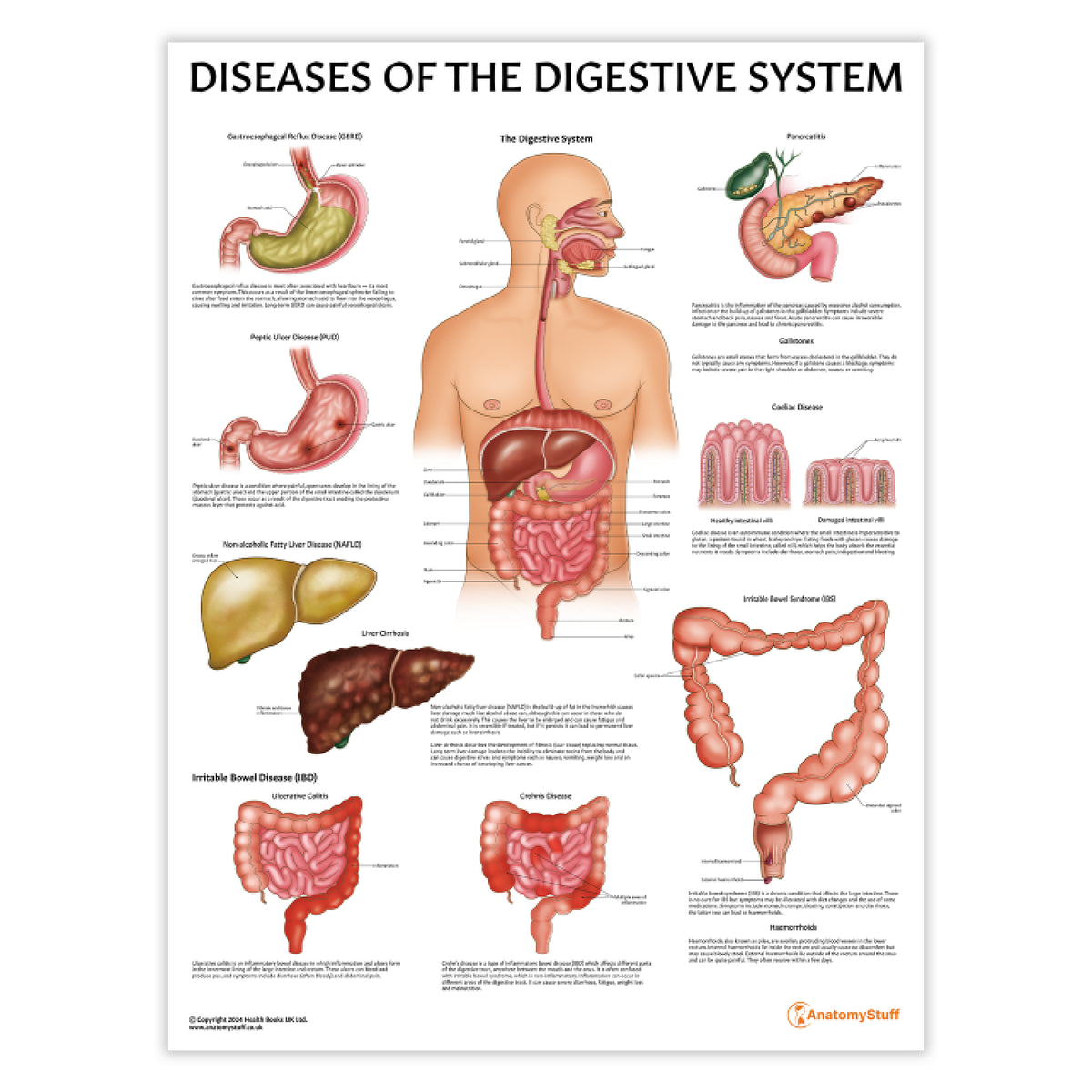Diseases of the Digestive System Poster | Educational Anatomy Chart ...