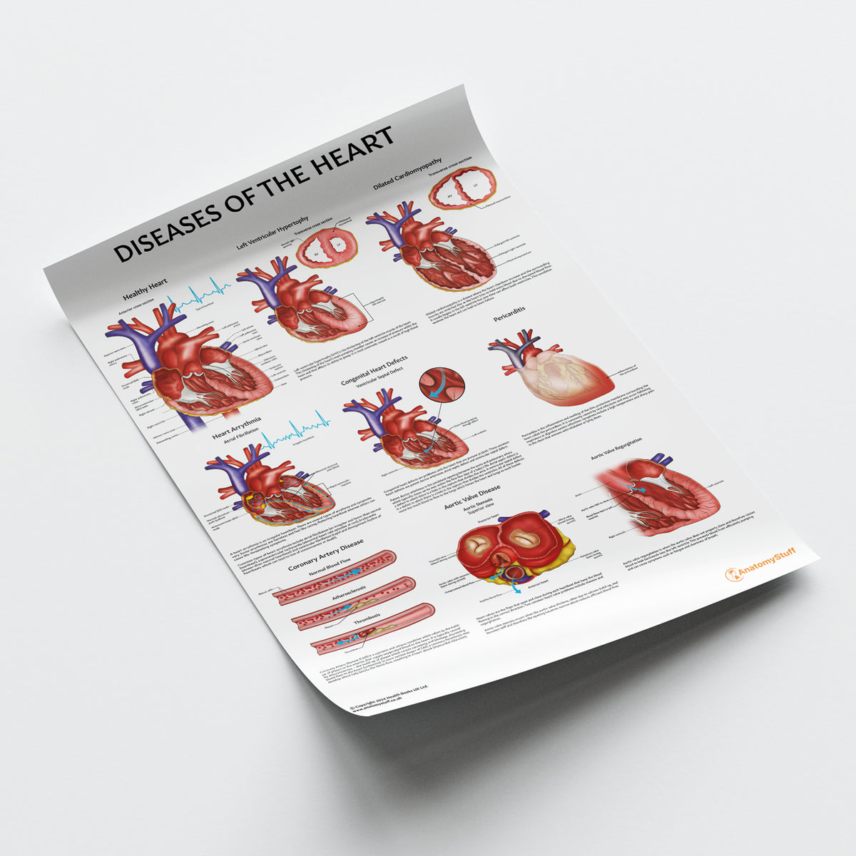 Diseases of the Heart Chart | Heart Conditions Poster | AnatomyStuff