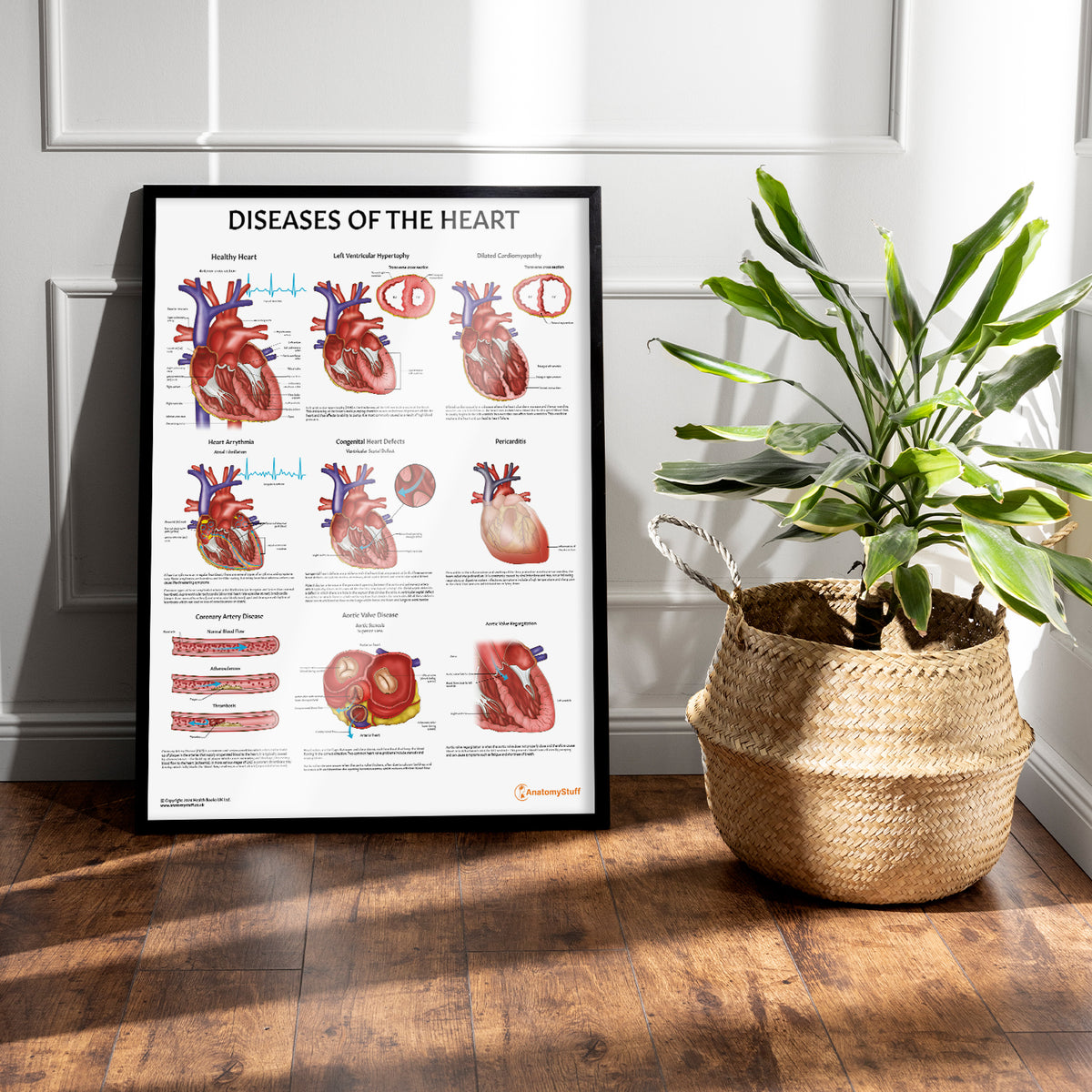 Diseases of the Heart Chart | Heart Conditions Poster | AnatomyStuff