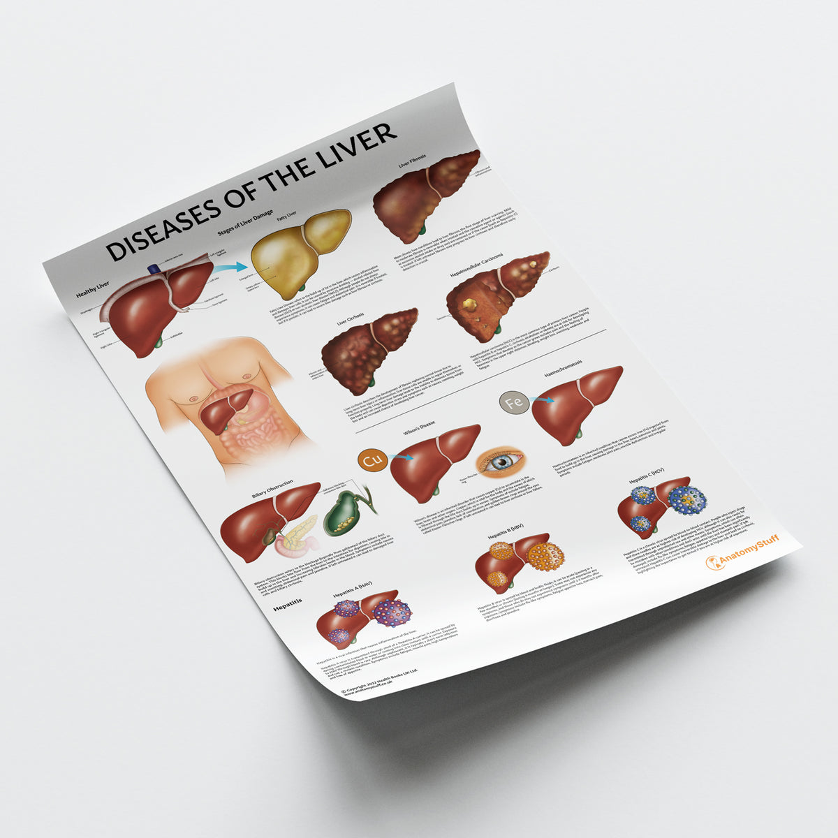 Diseases of the Liver Chart or Poster | Liver Anatomy & Conditions ...