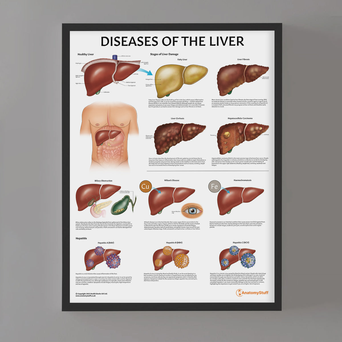 Diseases of the Liver Chart or Poster | Liver Anatomy & Conditions ...