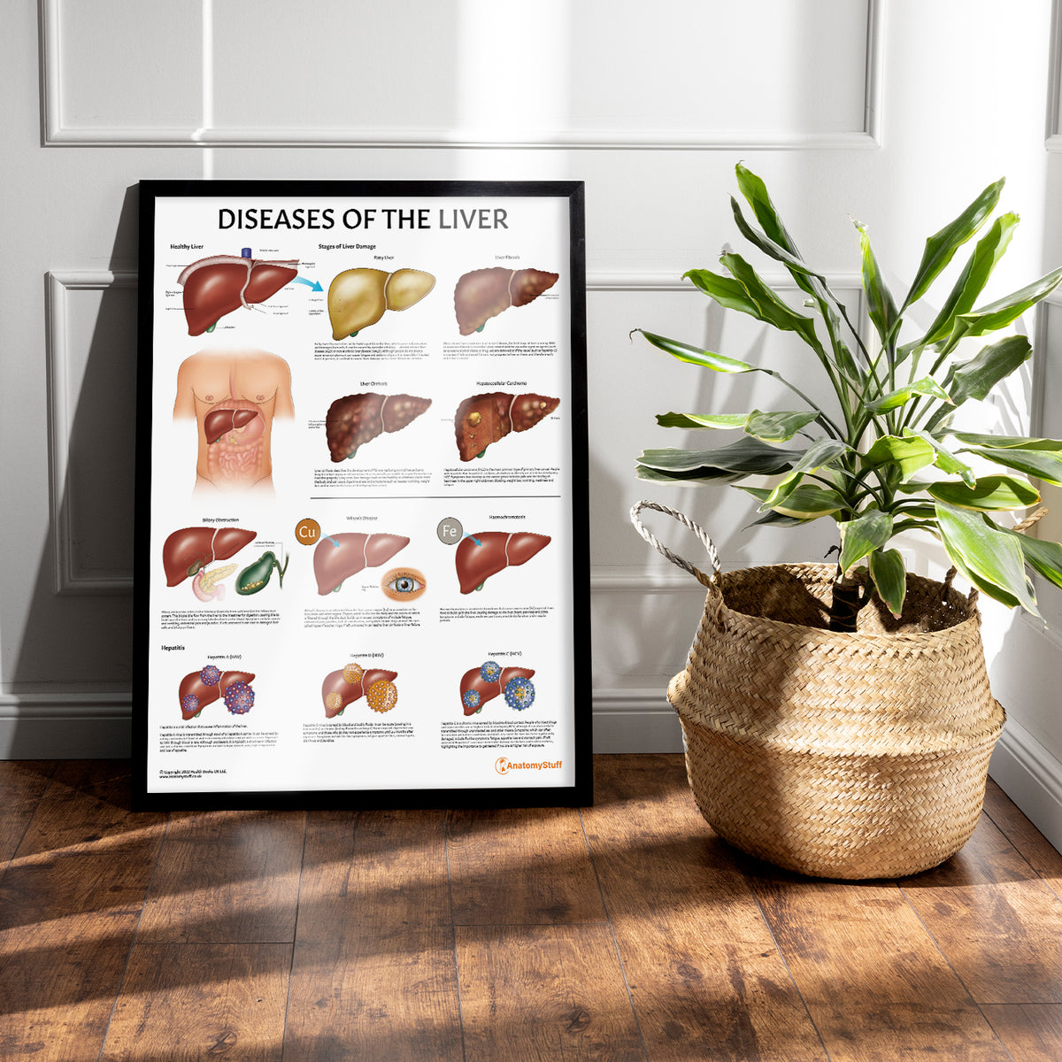 Diseases of the Liver Chart or Poster | Liver Anatomy & Conditions ...