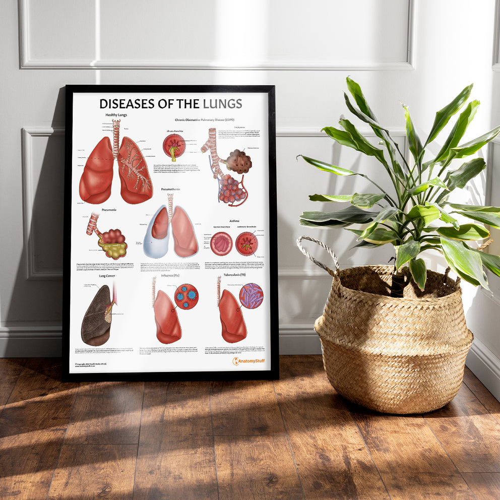 Lung Disease Anatomy Poster | COPD, Asthma, TB & More – AnatomyStuff