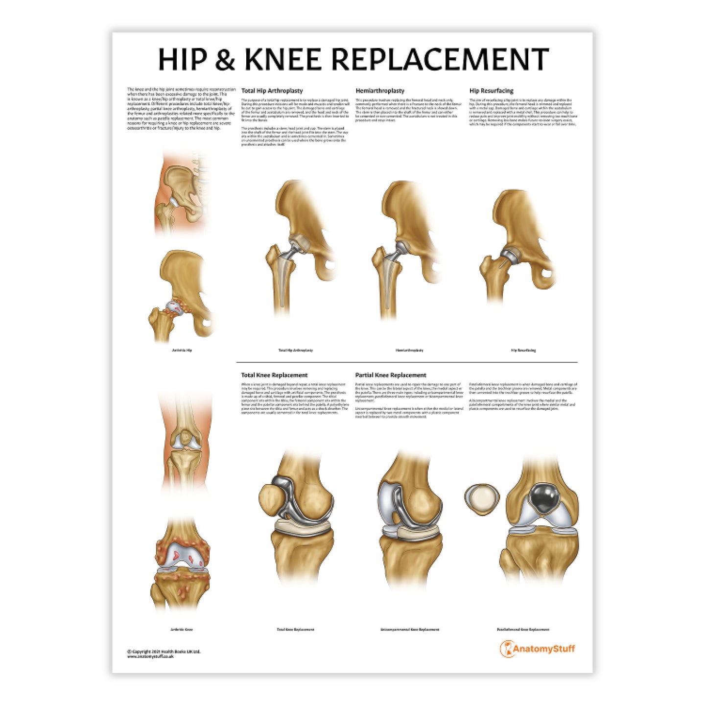 Hip and Knee Replacement Poster | Joint Surgery Anatomy Chart ...