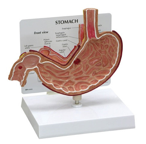 Stomach Ulcer Anatomical Model 2000 | Stomach Anatomy | GPI Anatomicals ...