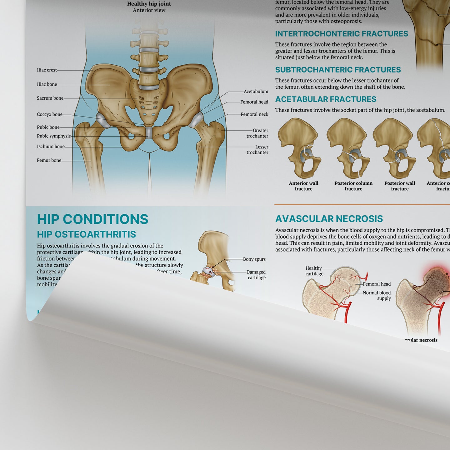 Anatomy of Hip Injuries & Conditions Poster | Hip Joint Chart ...