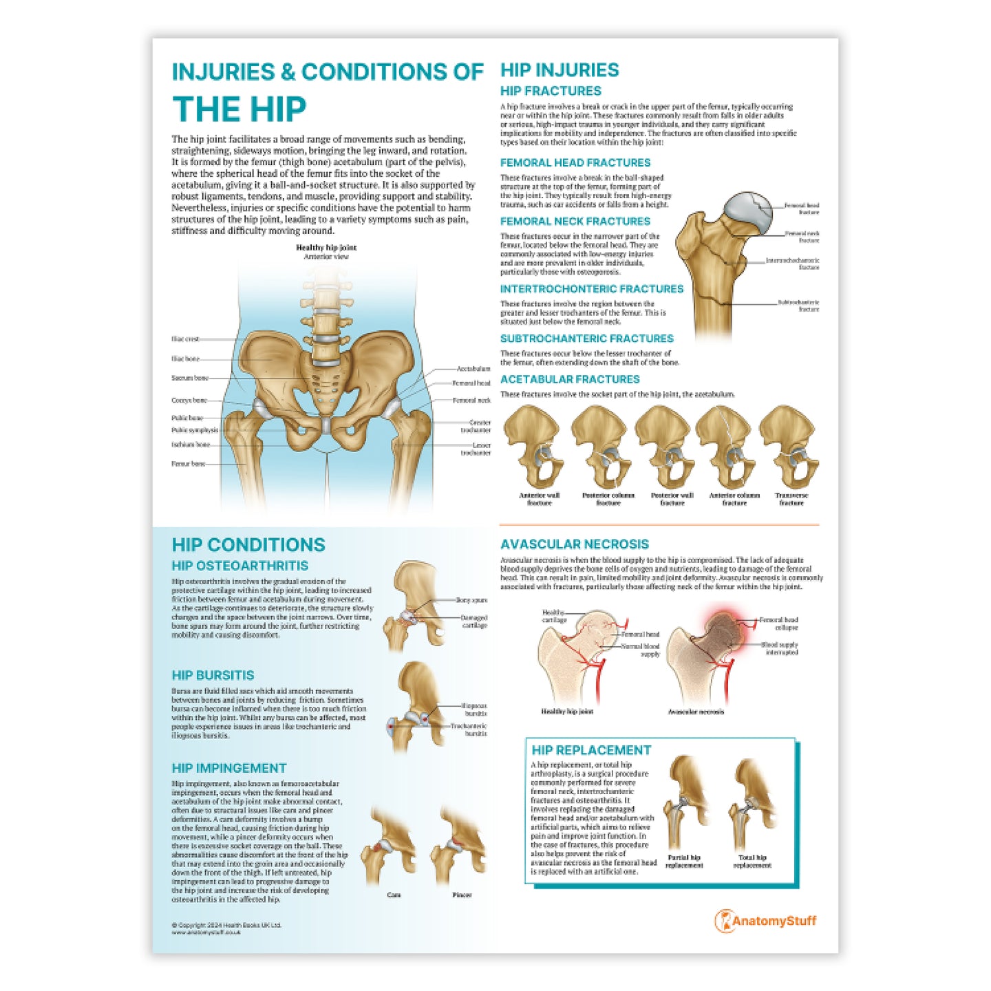 Anatomy of Hip Injuries & Conditions Poster | Hip Joint Chart ...