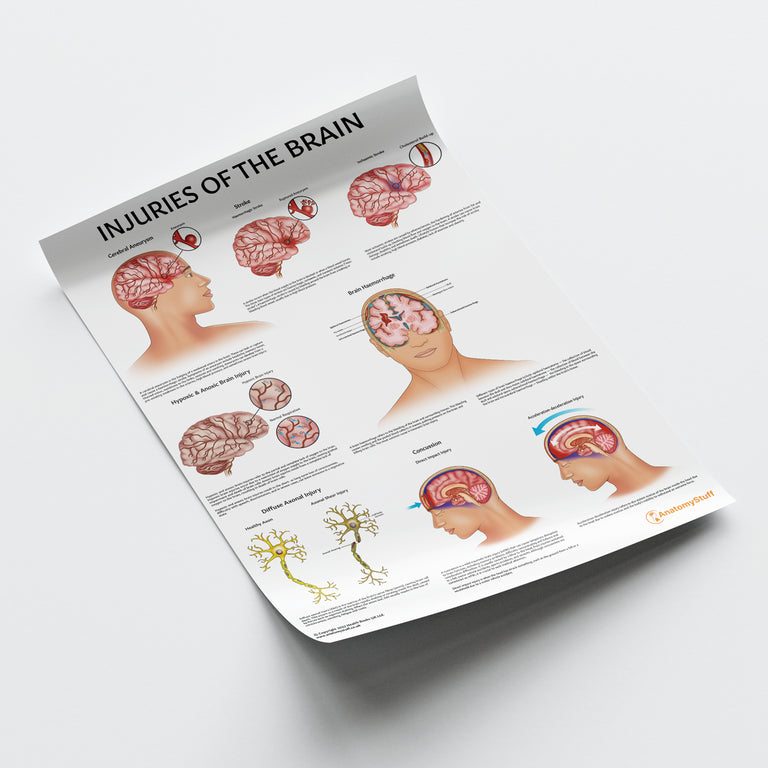 Injuries of the Brain Poster | Brain Trauma Anatomy Chart – AnatomyStuff