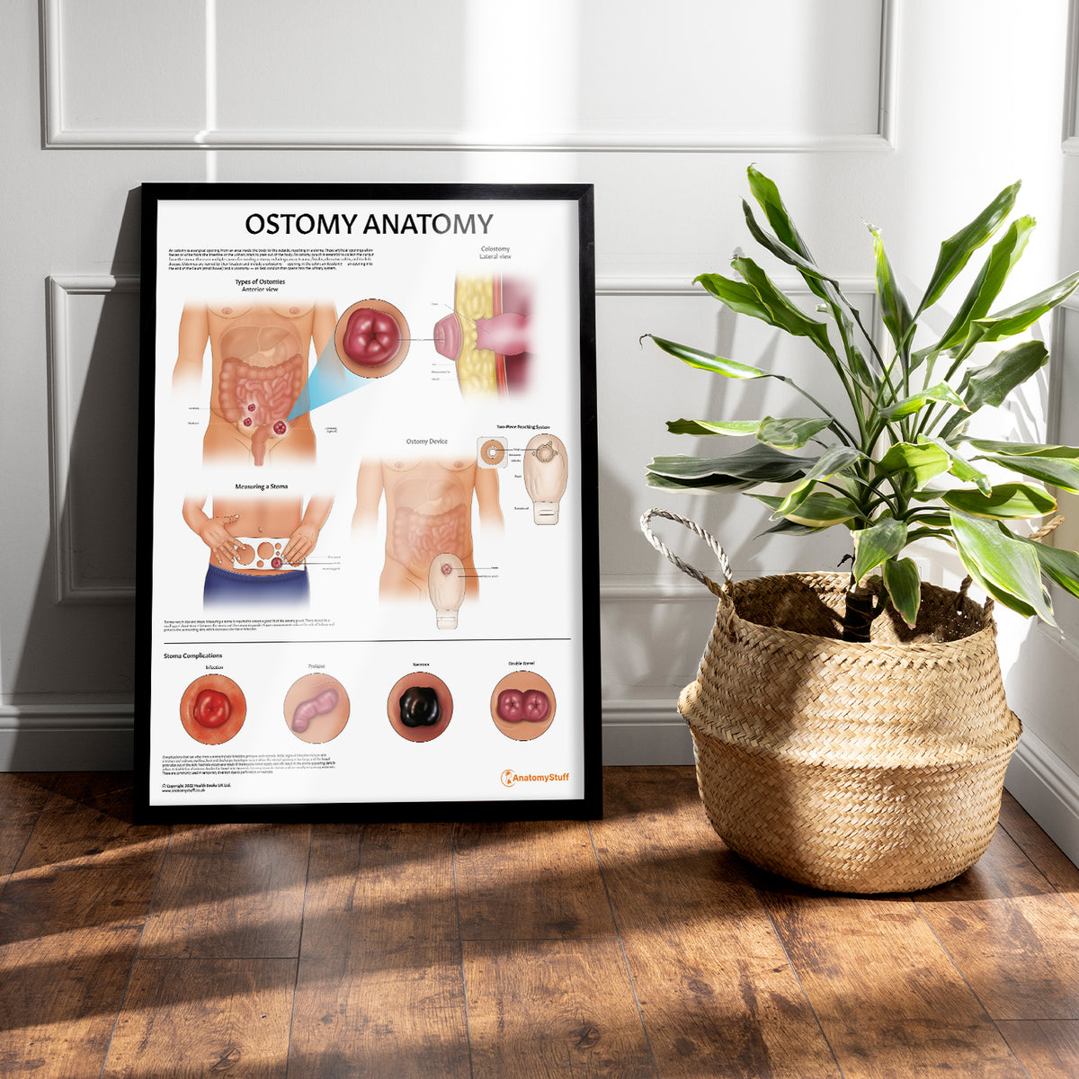Ostomy Anatomy Poster | Digestive and Urological Stoma Chart – AnatomyStuff