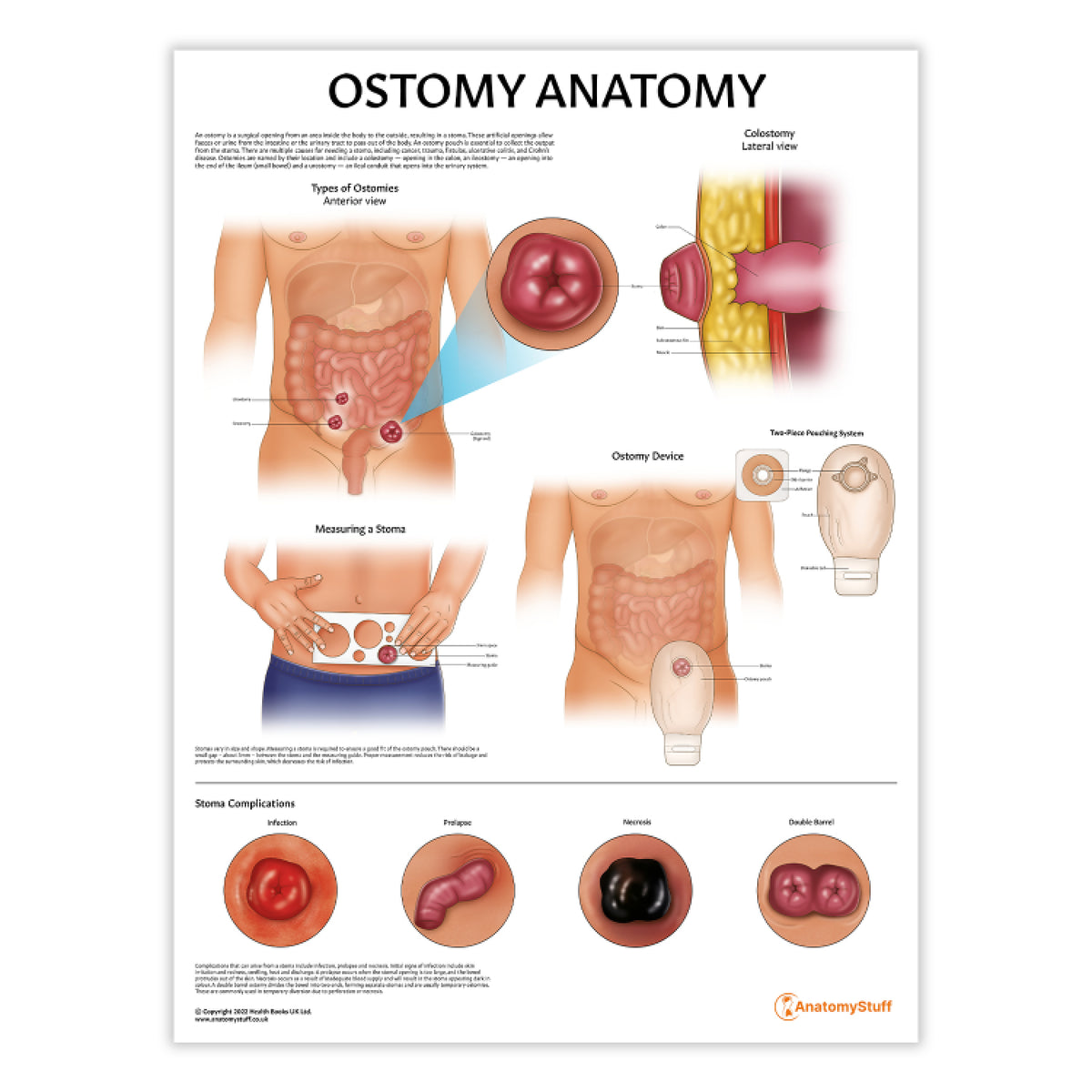 Ostomy Anatomy Poster | Digestive and Urological Stoma Chart – AnatomyStuff