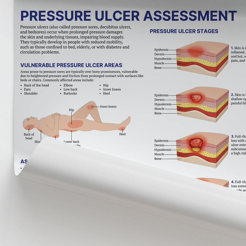Pressure Ulcer Assessment Poster | Wound Care Education Chart ...