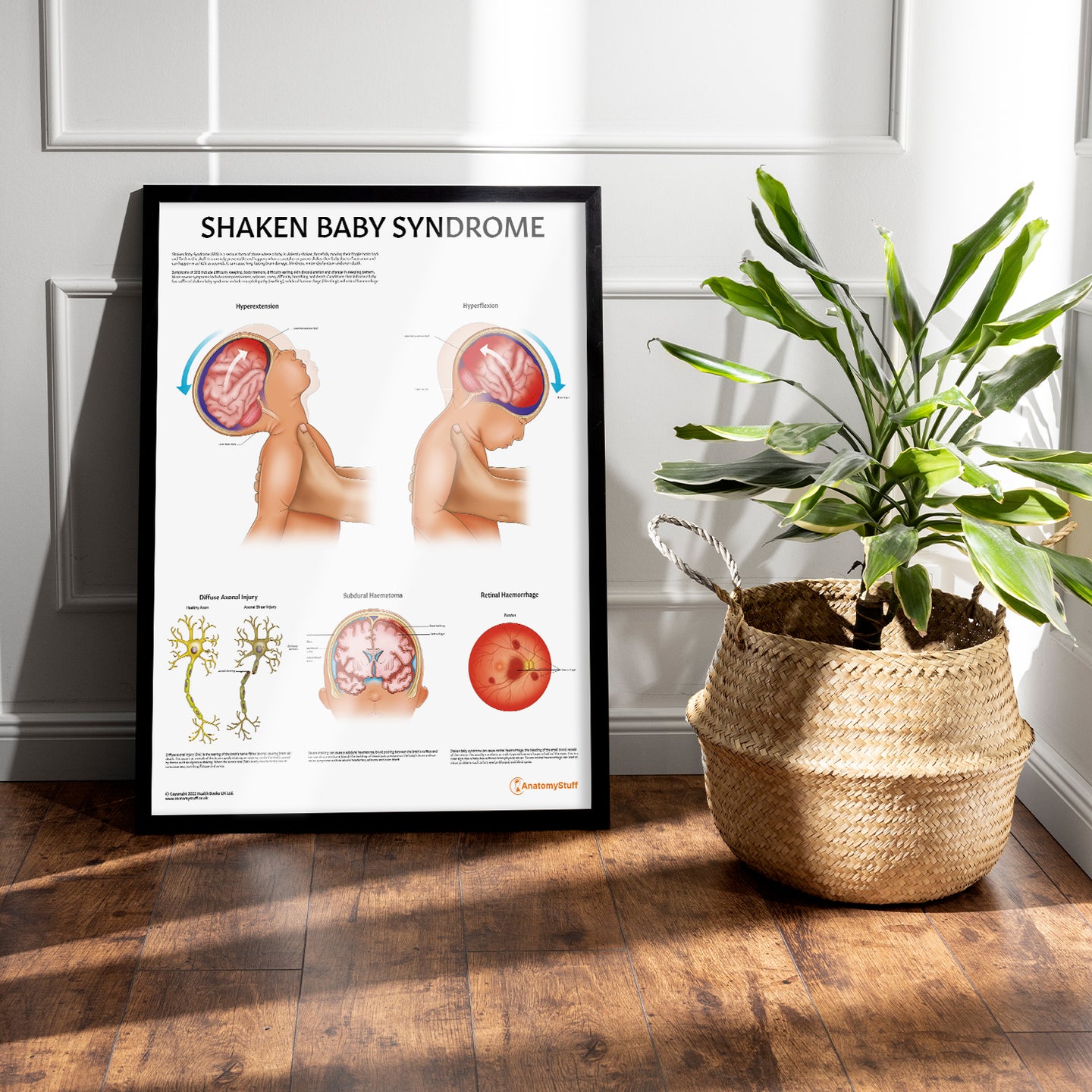 Infant Head Trauma Chart | Shaken Baby Syndrome Educational Poster ...