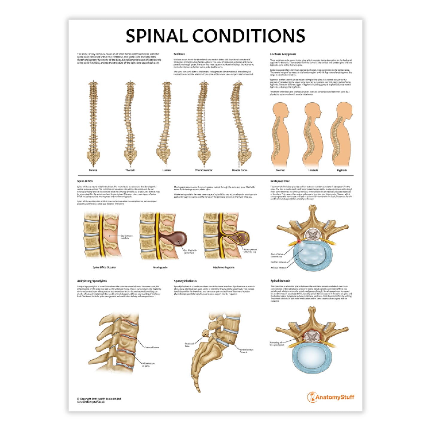 Spinal Conditions Poster | Spine Pathology Educational Chart – AnatomyStuff