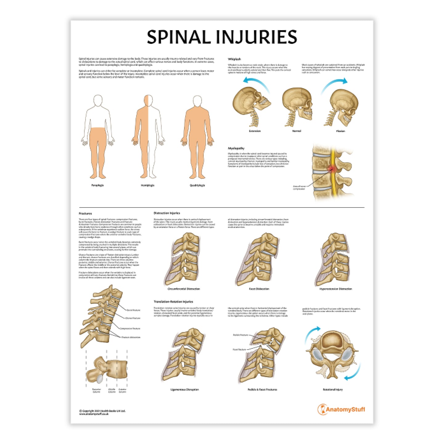 Spinal Injuries Poster | Spine Injury Education Chart – AnatomyStuff