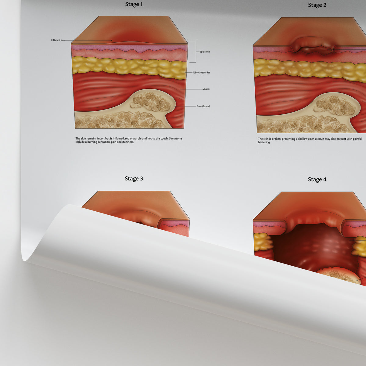 Pressure Ulcer Stages Chart | Bedsore & Decubitus Injury Poster ...