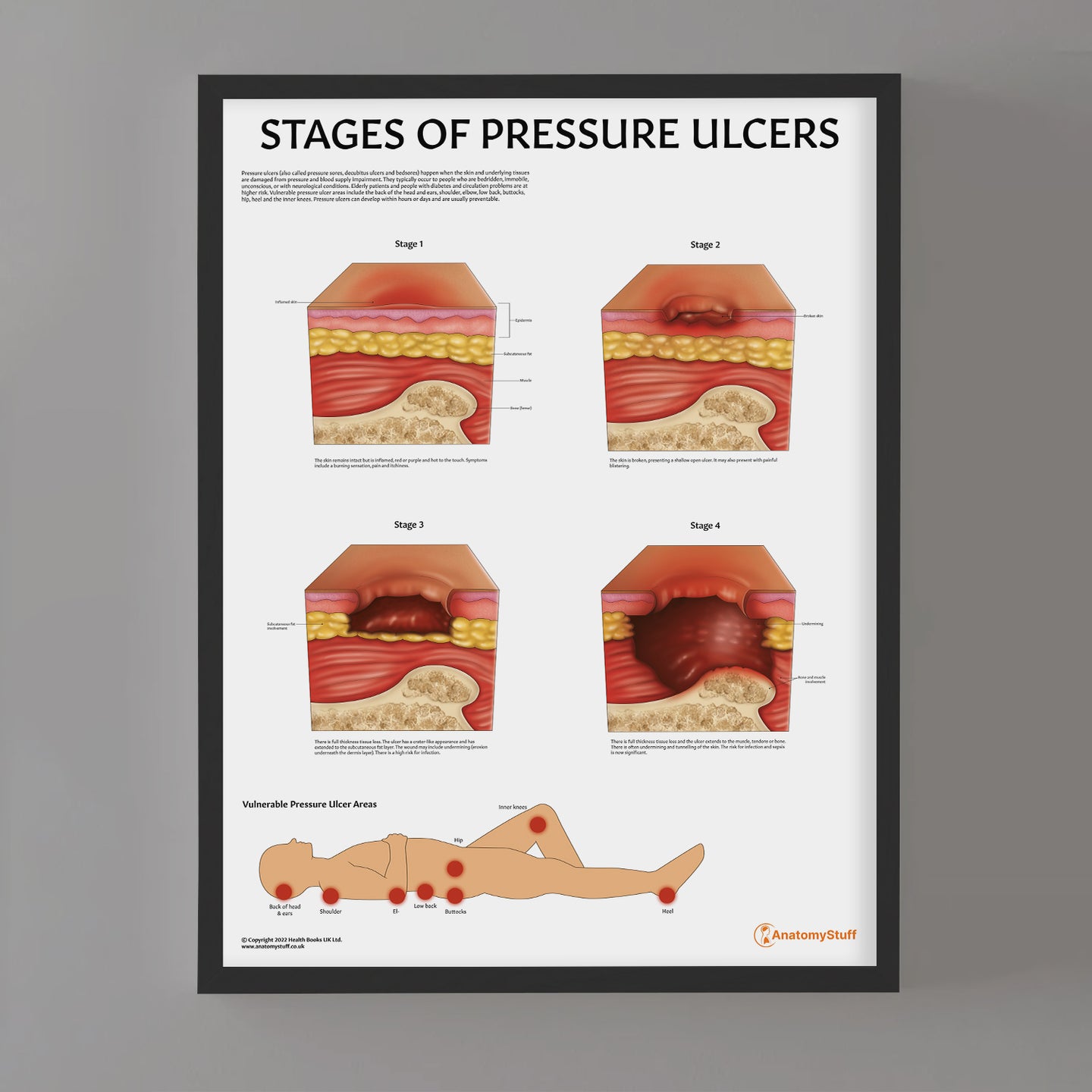 Pressure Ulcer Stages Chart | Bedsore & Decubitus Injury Poster ...