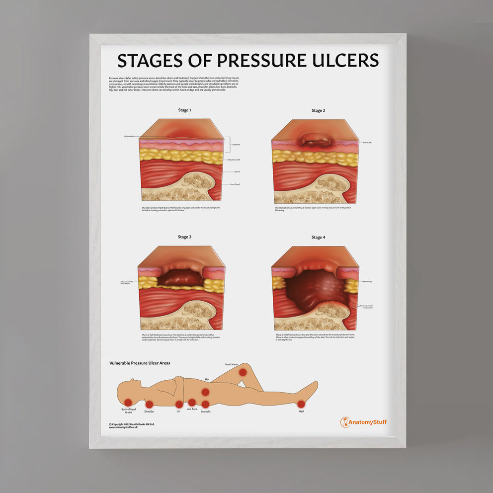 Pressure Ulcer Stages Chart | Bedsore & Decubitus Injury Poster – AnatomyStuff