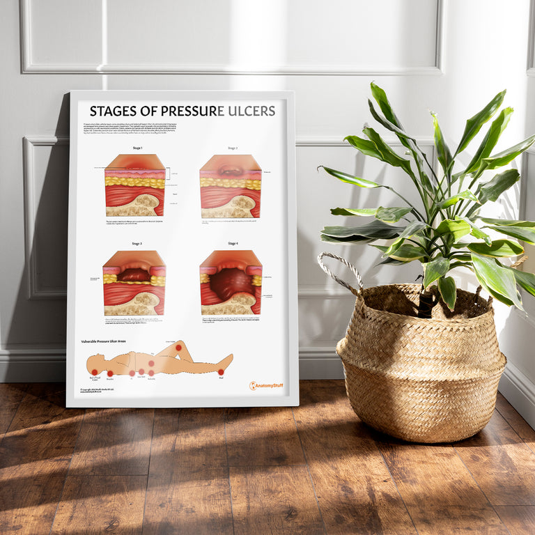 Pressure Ulcer Stages Chart | Bedsore & Decubitus Injury Poster ...