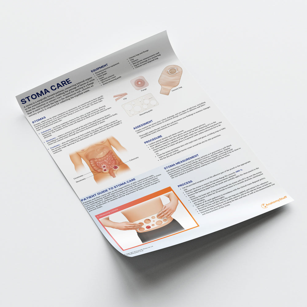 Stoma Care Poster | Ostomy Assessment and Patient Support Chart ...