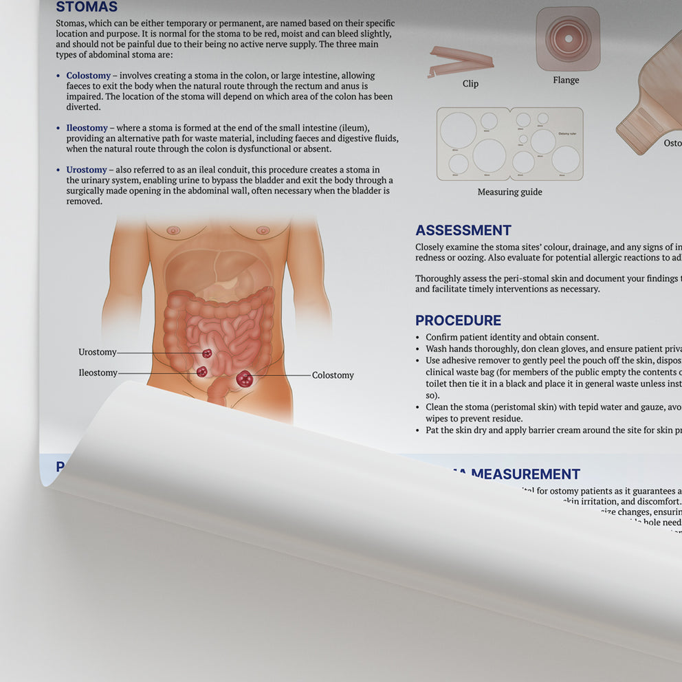 Stoma Care Poster | Ostomy Assessment and Patient Support Chart ...