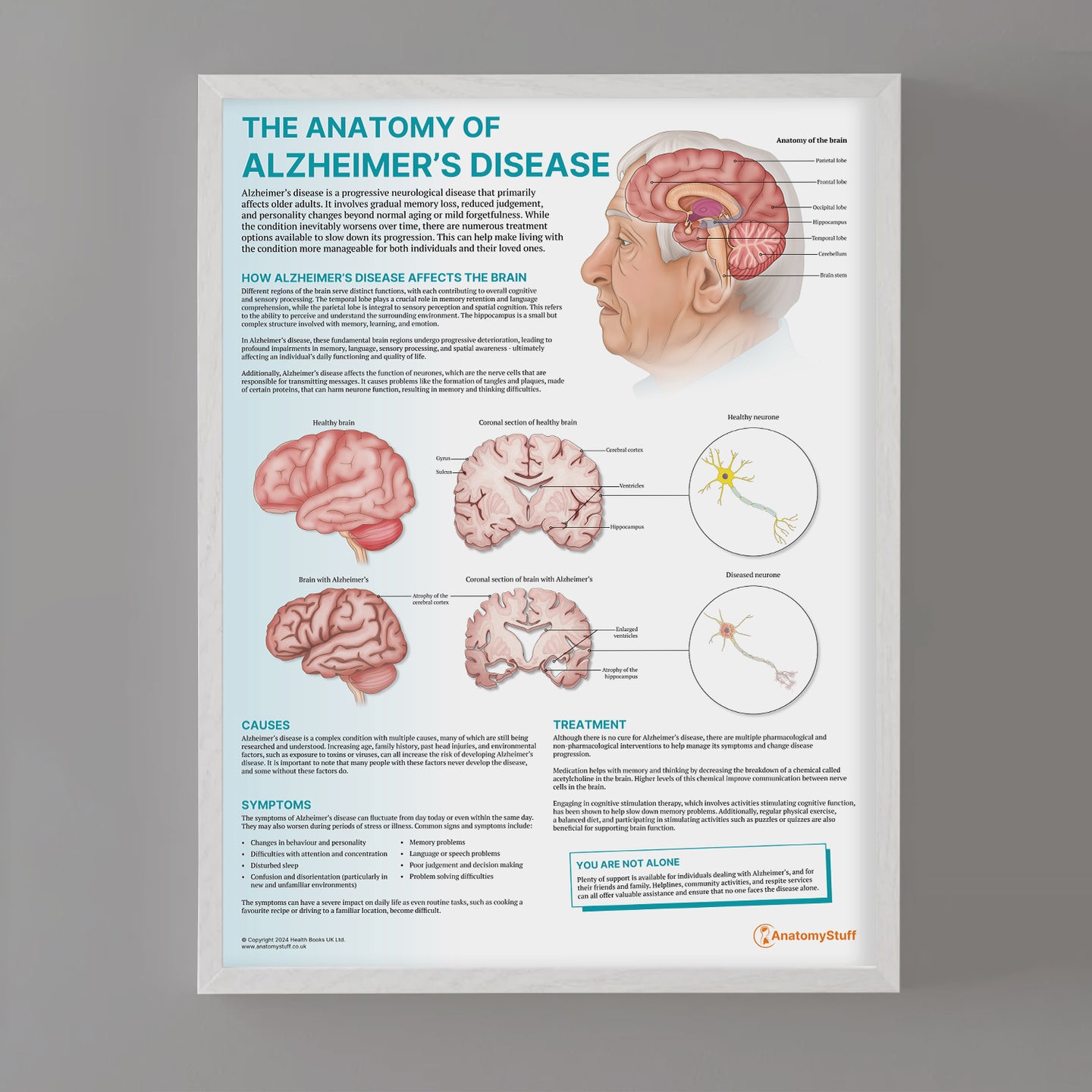 The Anatomy of Alzheimer's Disease Chart | Brain Health Poster ...