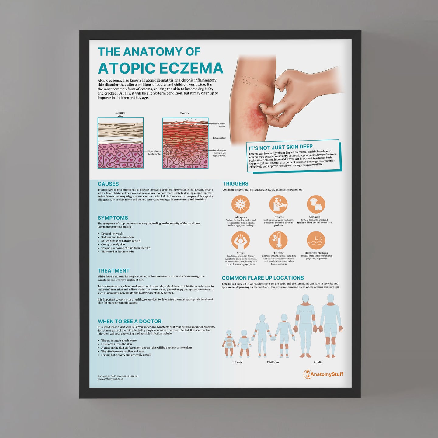 The Anatomy of Atopic Eczema Chart | Dermatology Poster – AnatomyStuff