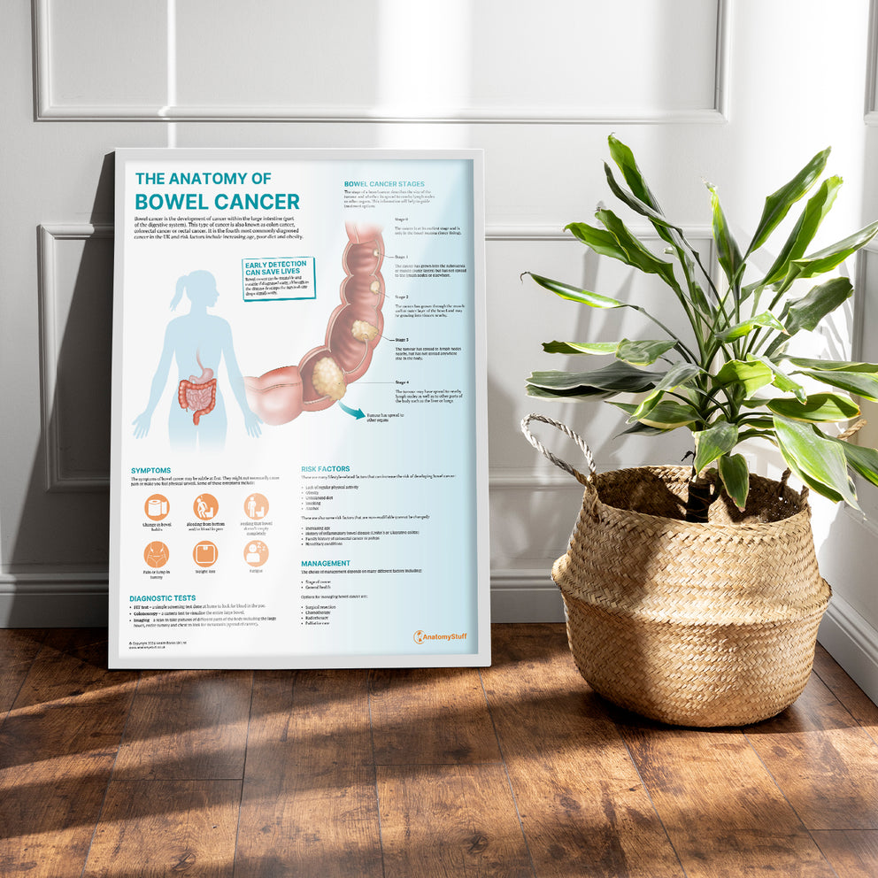 The Anatomy of Bowel Cancer Chart | Gastroenterology Poster – AnatomyStuff