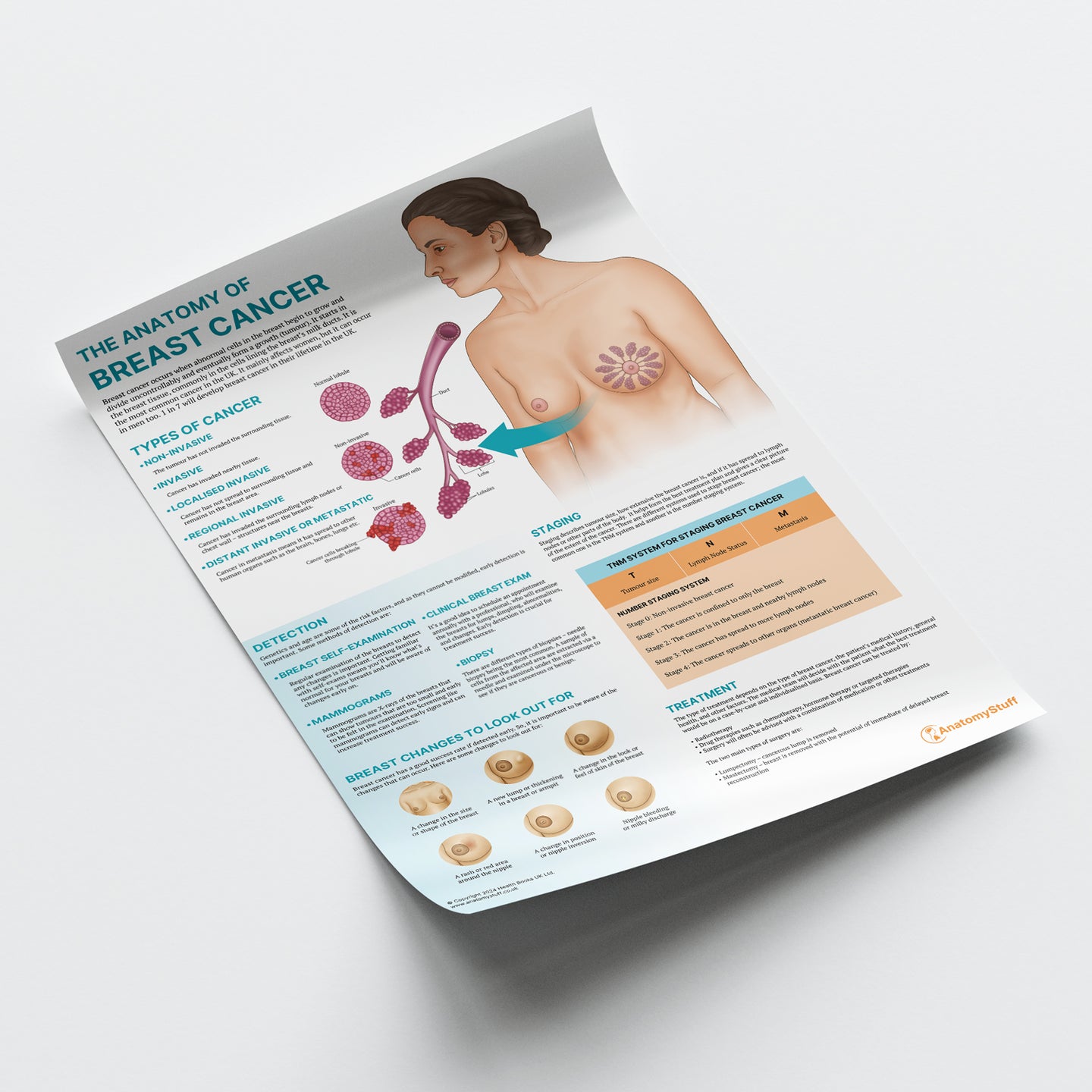 Anatomy of Breast Cancer Chart | Breast Cancer Awareness Poster ...