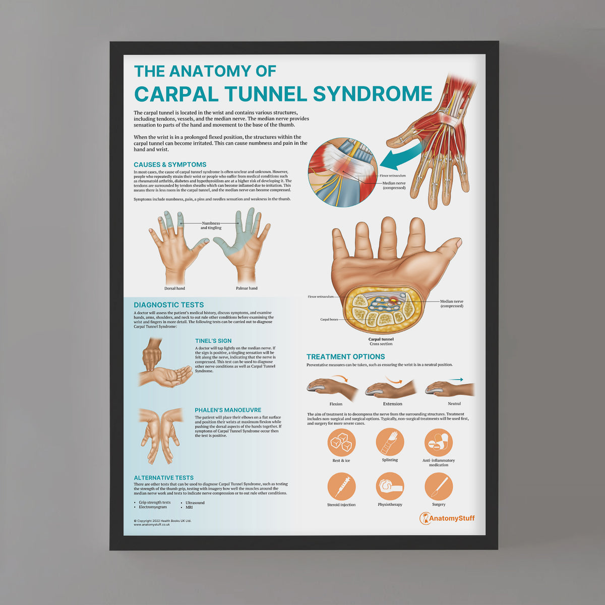The Anatomy of Carpal Tunnel Syndrome Chart | Hand & Wrist Poster ...