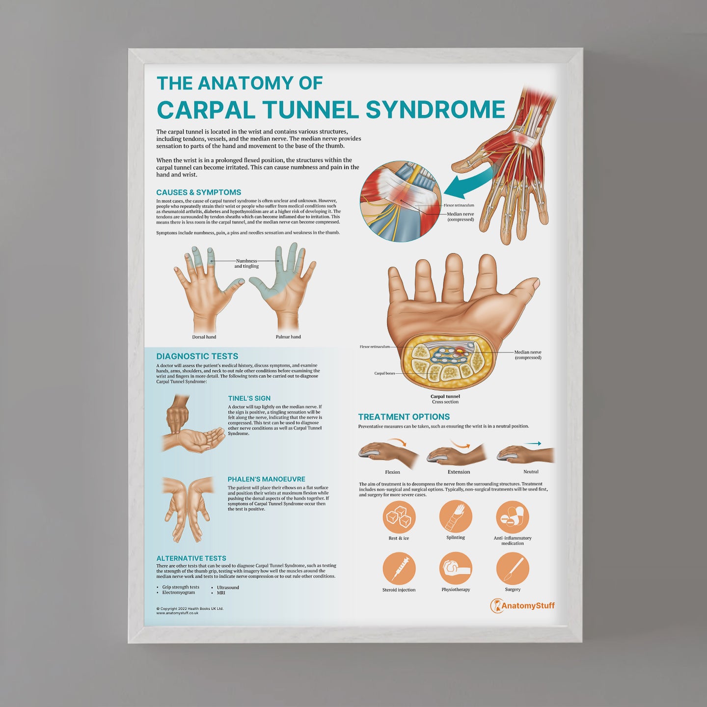 The Anatomy of Carpal Tunnel Syndrome Chart | Hand & Wrist Poster ...