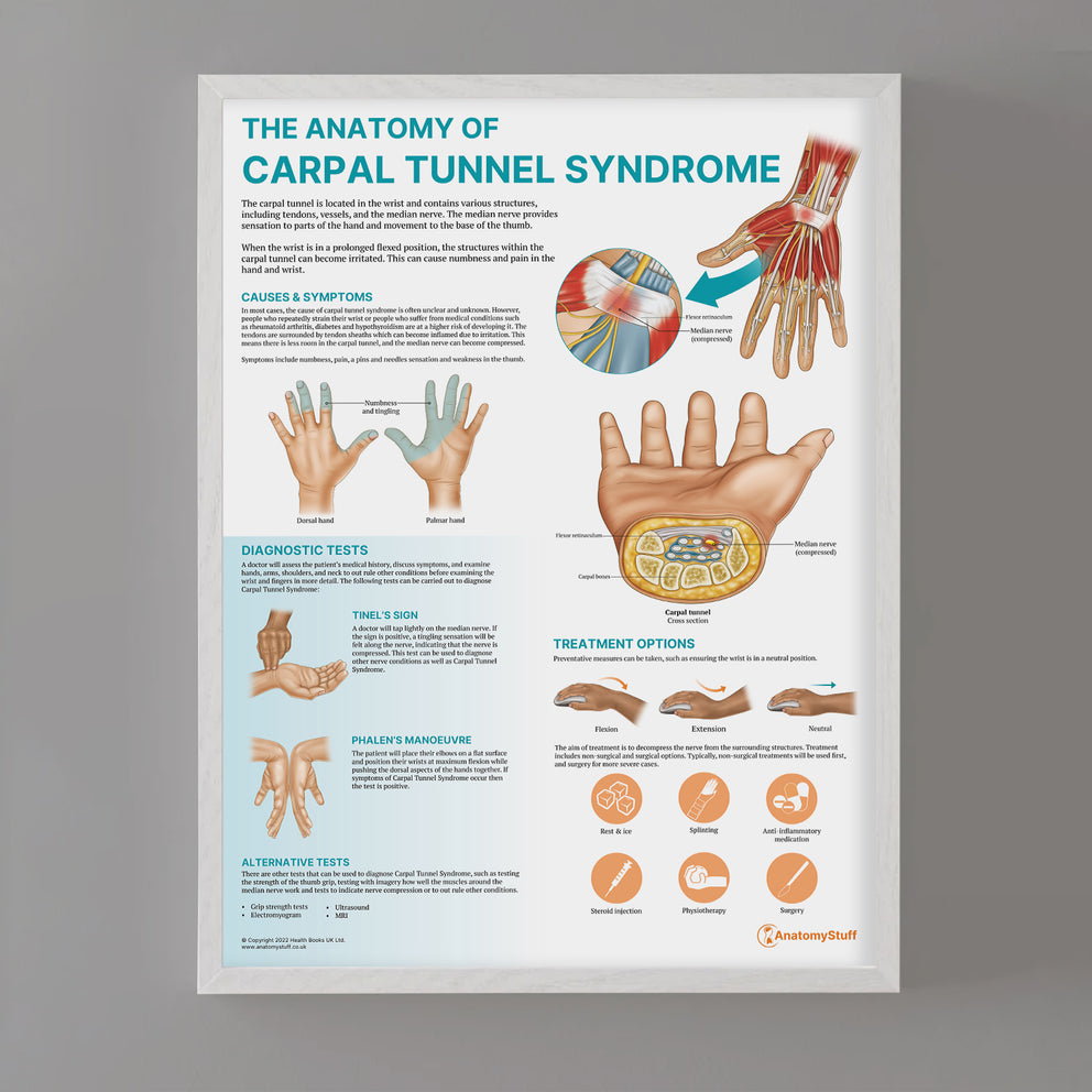 The Anatomy of Carpal Tunnel Syndrome Chart | Hand & Wrist Poster ...