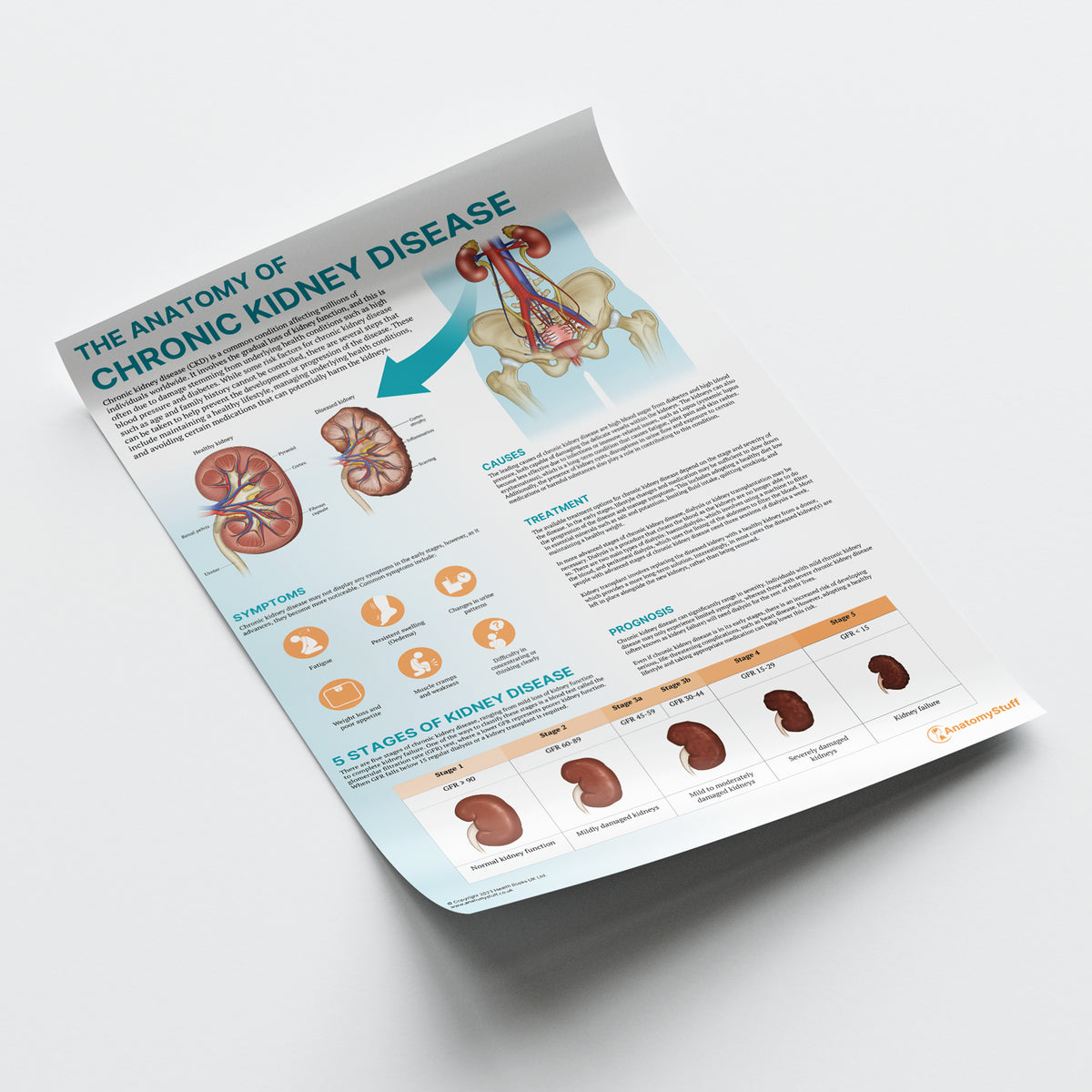 The Anatomy of Chronic Kidney Disease Chart | Kidney Health Poster ...