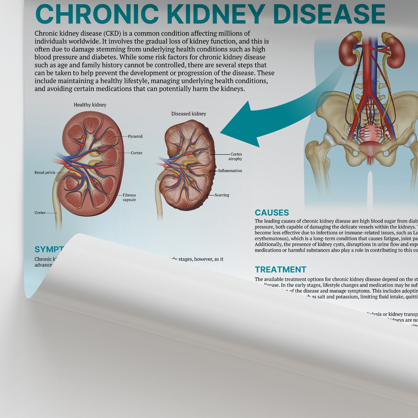 The Anatomy of Chronic Kidney Disease Chart | Kidney Health Poster ...