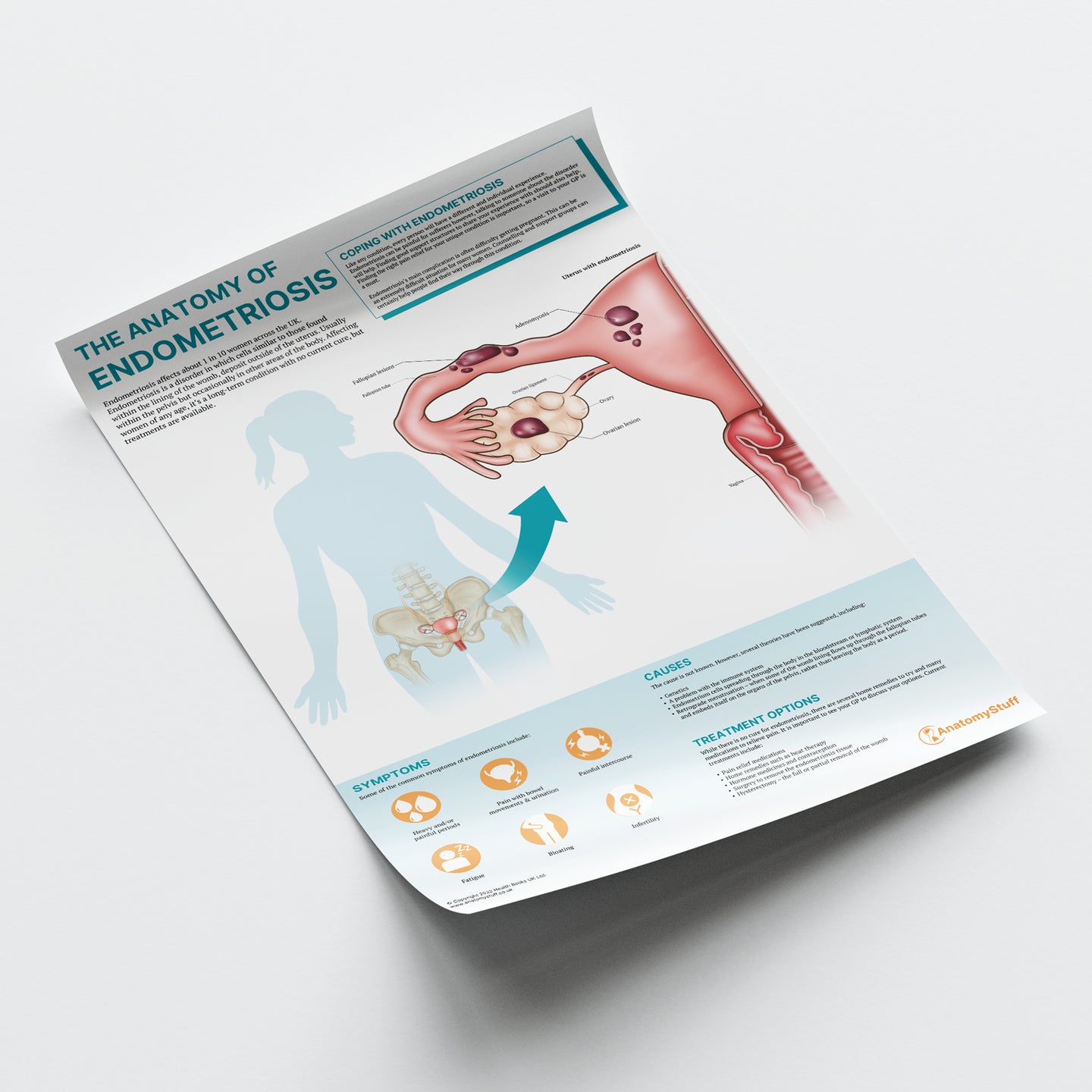 Anatomy of Endometriosis Chart | Causes, Symptoms & Treatment Poster ...
