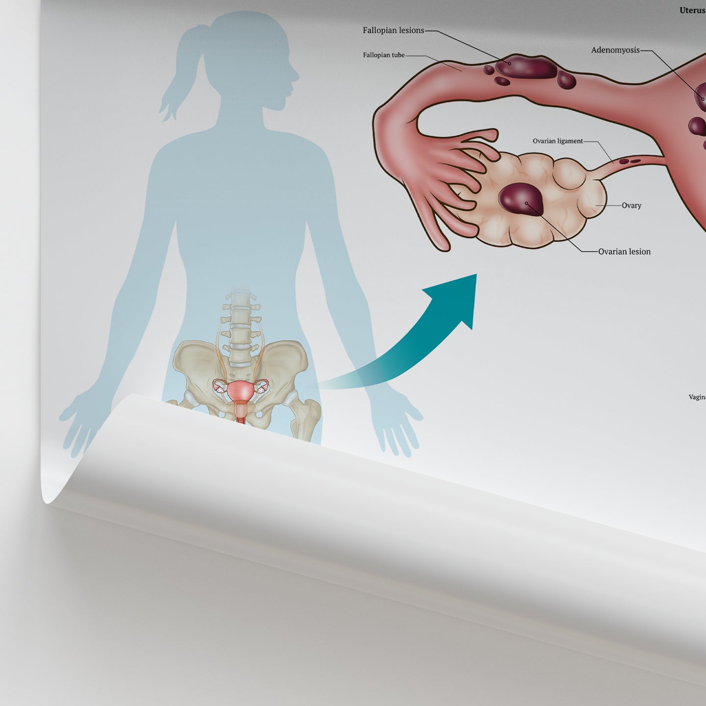 Anatomy of Endometriosis Chart | Causes, Symptoms & Treatment Poster ...