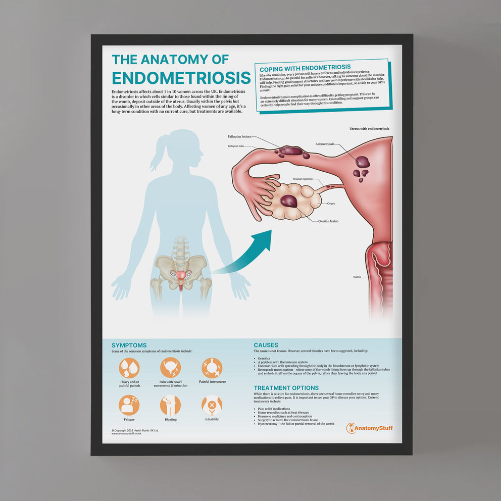 Anatomy of Endometriosis Chart | Causes, Symptoms & Treatment Poster ...
