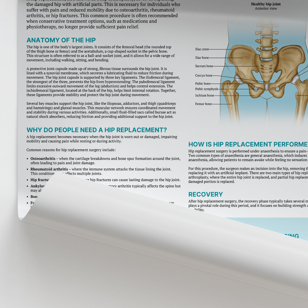 Hip Replacement Anatomy Poster | Surgical Procedure & Recovery Chart ...