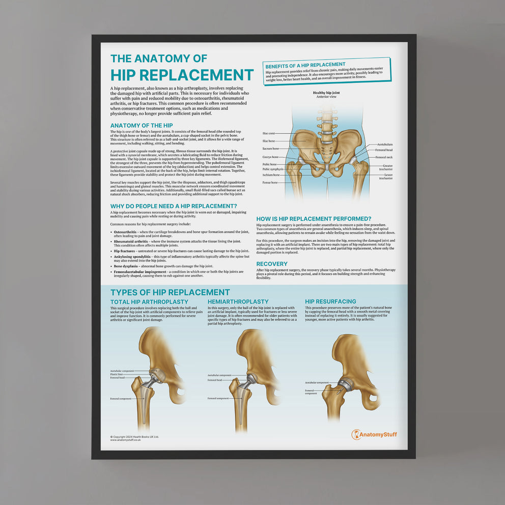 Hip Replacement Anatomy Poster | Surgical Procedure & Recovery Chart – AnatomyStuff