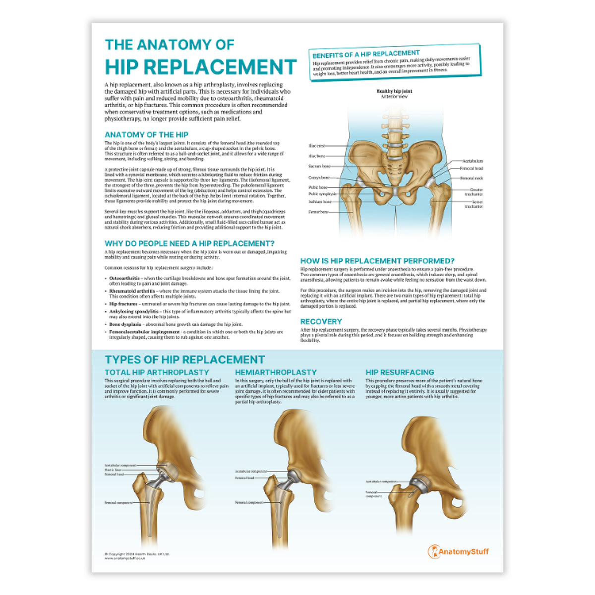 Knee Replacement Model | Hip Replacement Trainers – AnatomyStuff