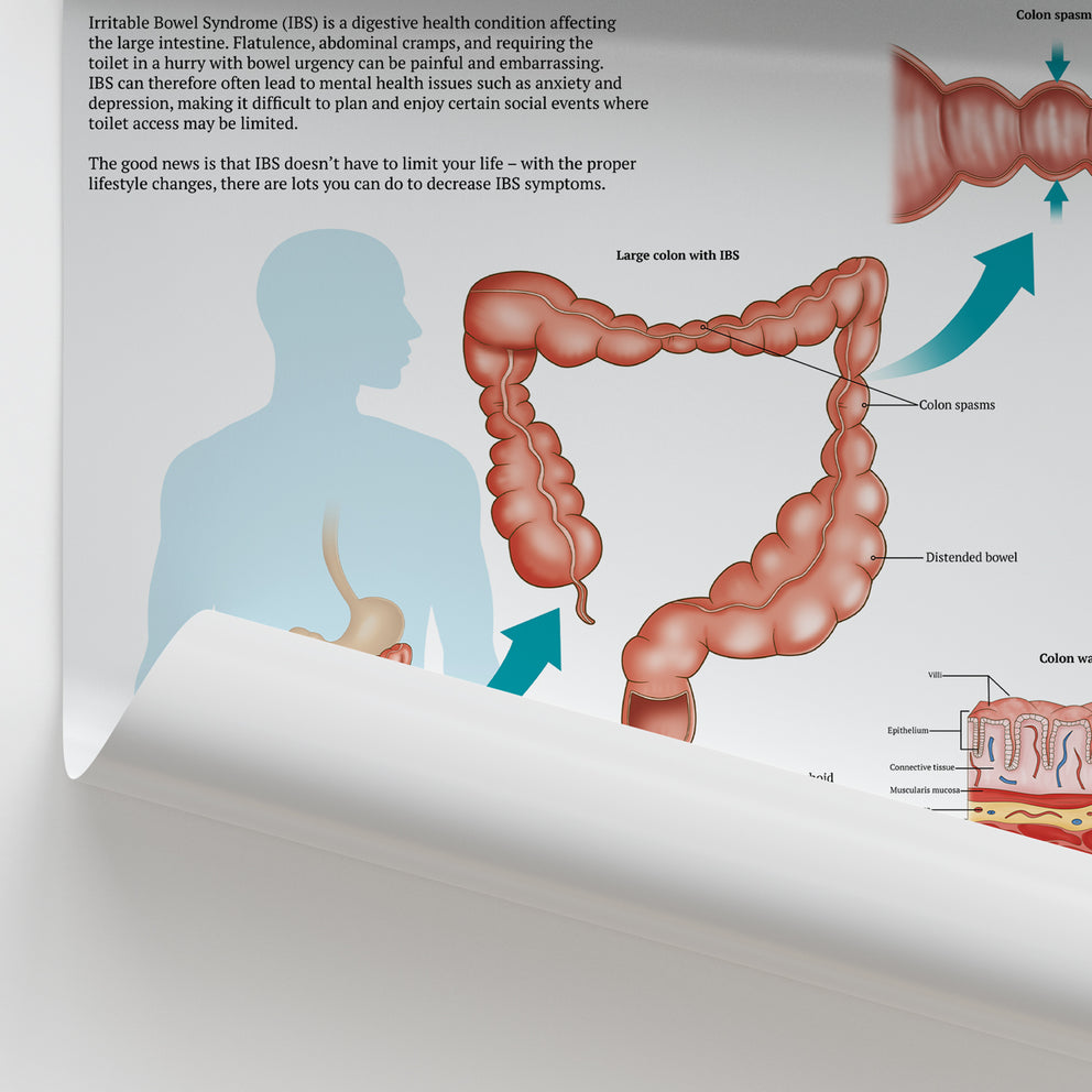 Anatomy of Irritable Bowel Syndrome (IBS) Chart | Patient Education ...