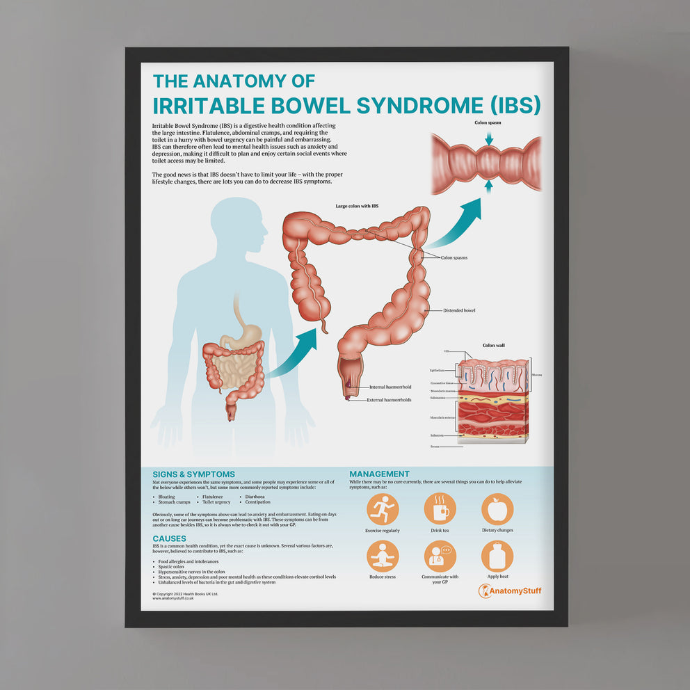 Anatomy of Irritable Bowel Syndrome (IBS) Chart | Patient Education ...