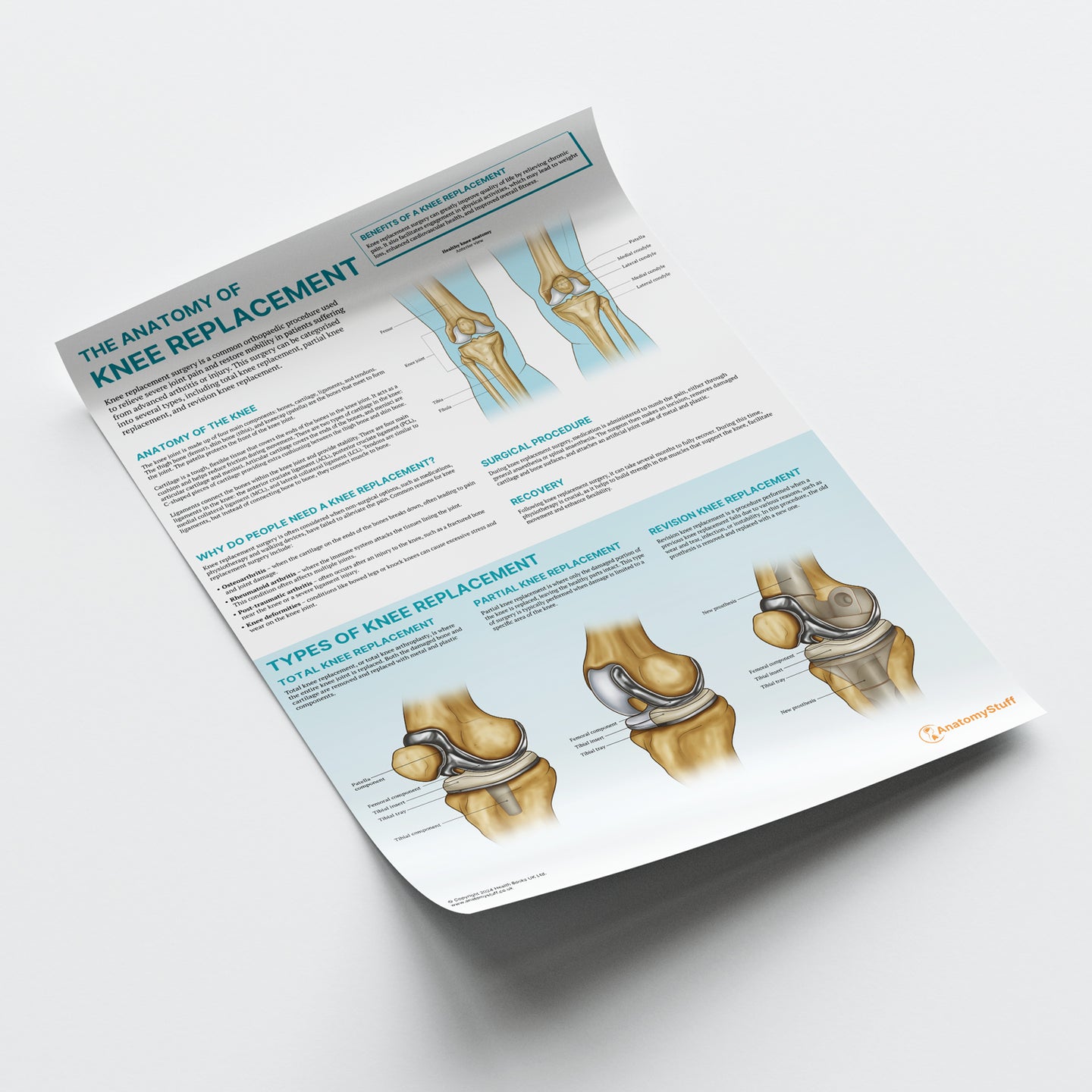 Knee Replacement Anatomy Poster | Surgical Procedure & Recovery Chart ...